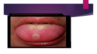 syphilis, gonorrhea and noma | PPT