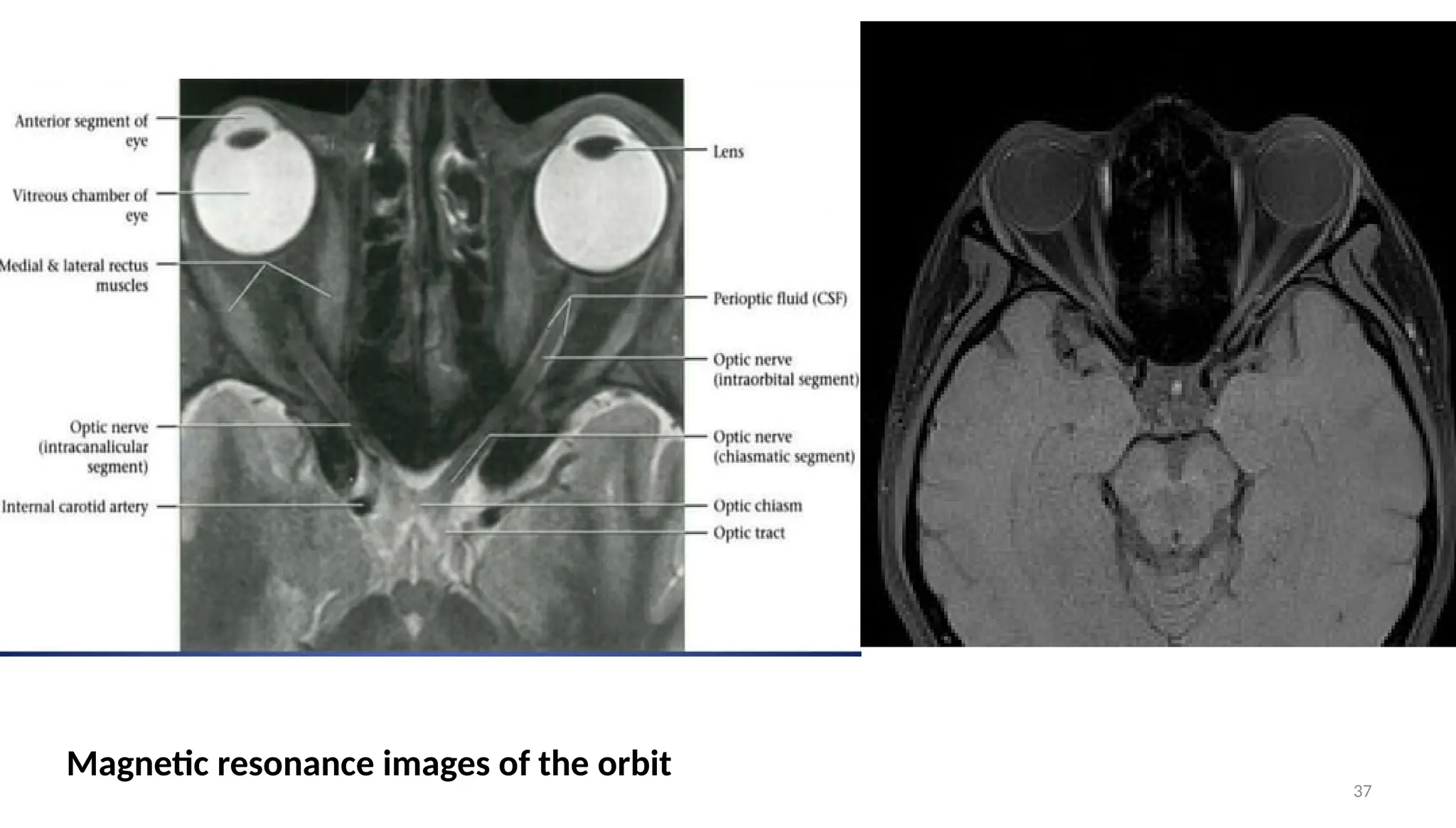 Presentation on Radiological Anatomy of the Orbit | PPTX