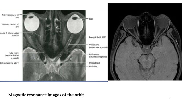 Presentation on Radiological Anatomy of the Orbit | PPTX