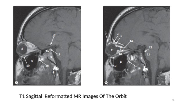 Presentation on Radiological Anatomy of the Orbit | PPTX