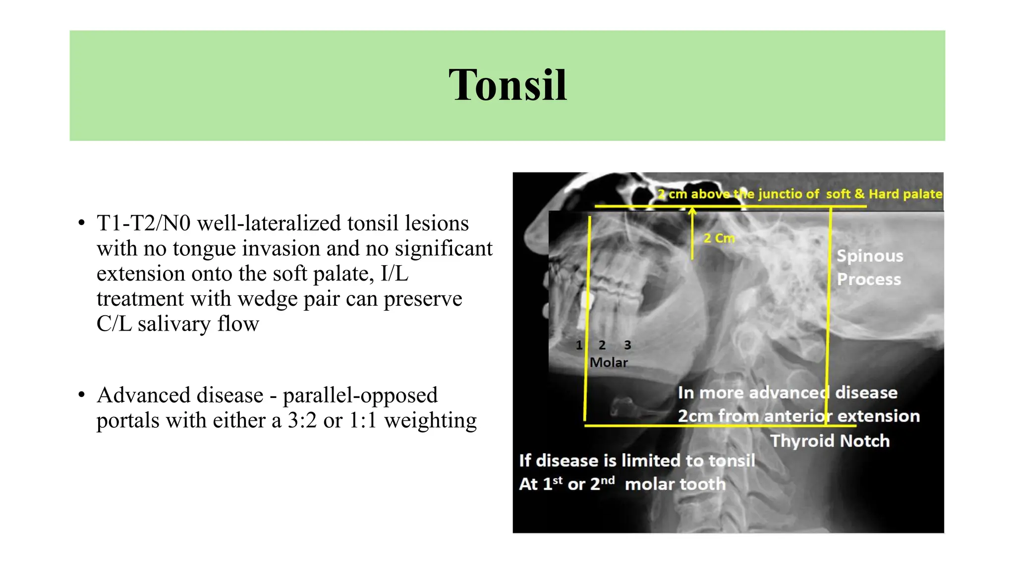 Oropharyngeal carcinoma management principles | PPTX