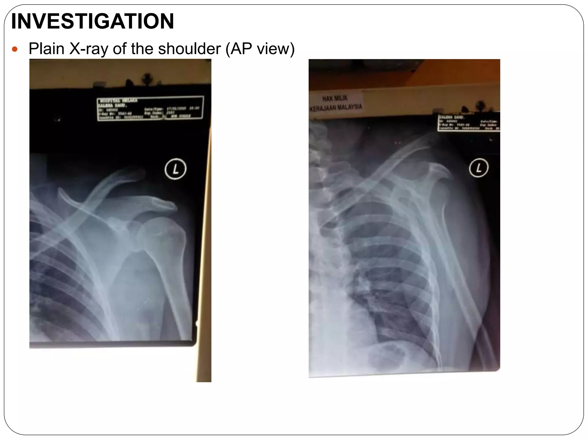 Acromioclavicular Joint Dislocation | PPTX