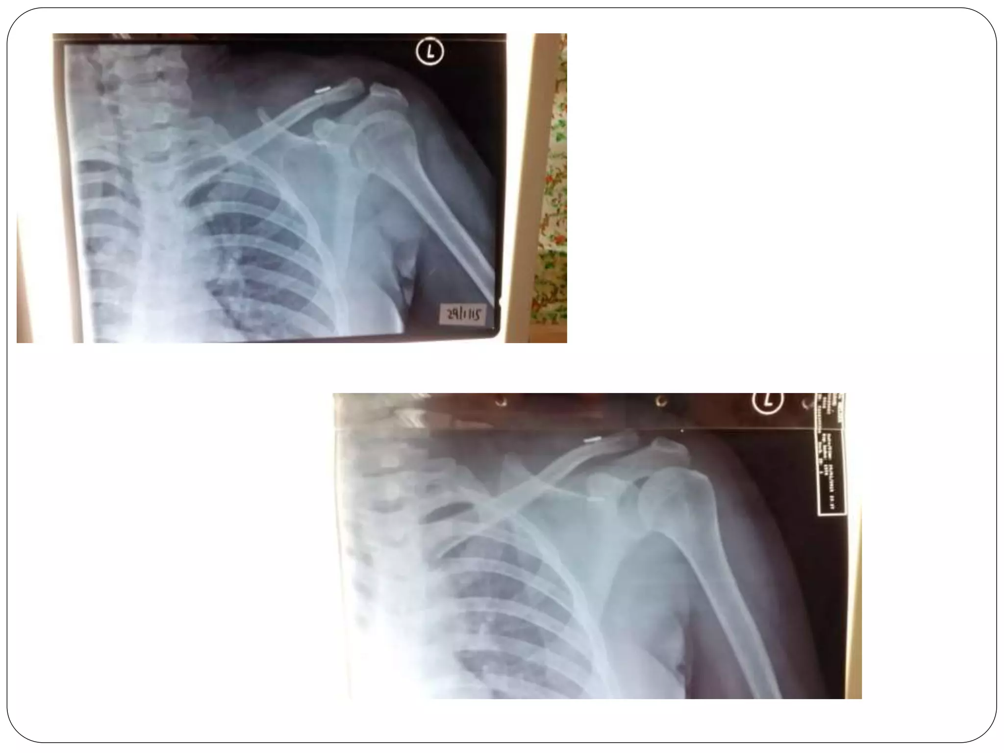 Acromioclavicular Joint Dislocation | PPTX