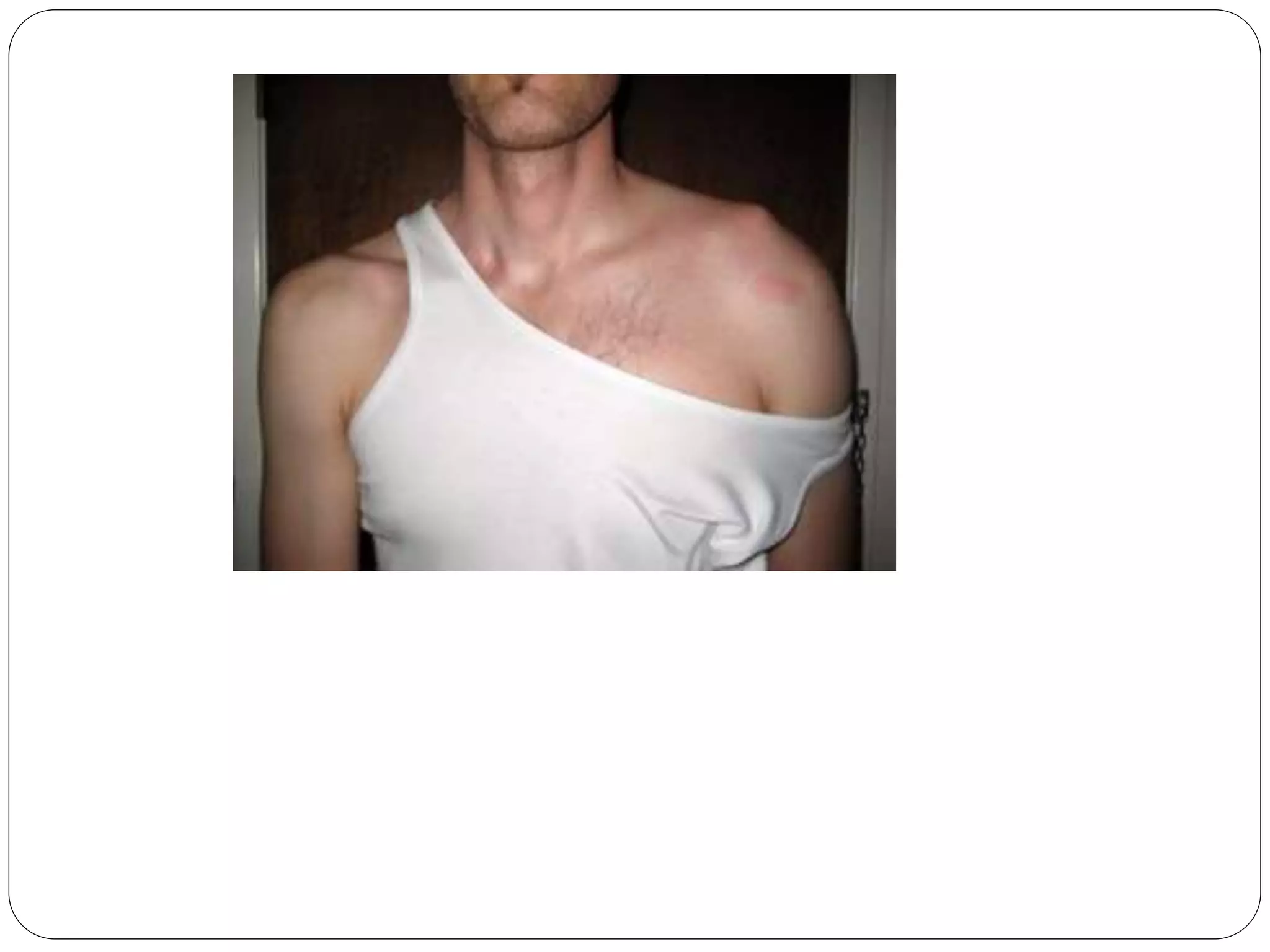 Acromioclavicular Joint Dislocation | PPTX