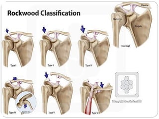 Acromioclavicular Joint Dislocation | PPTX