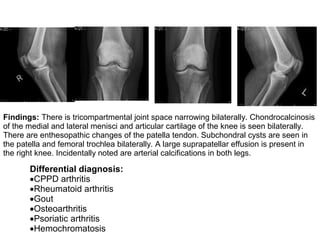Pseudo GOUT knee | PPT