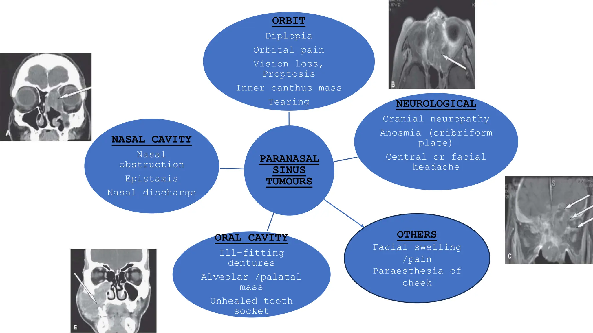 Paranasal sinus tumours - management principles | PPTX