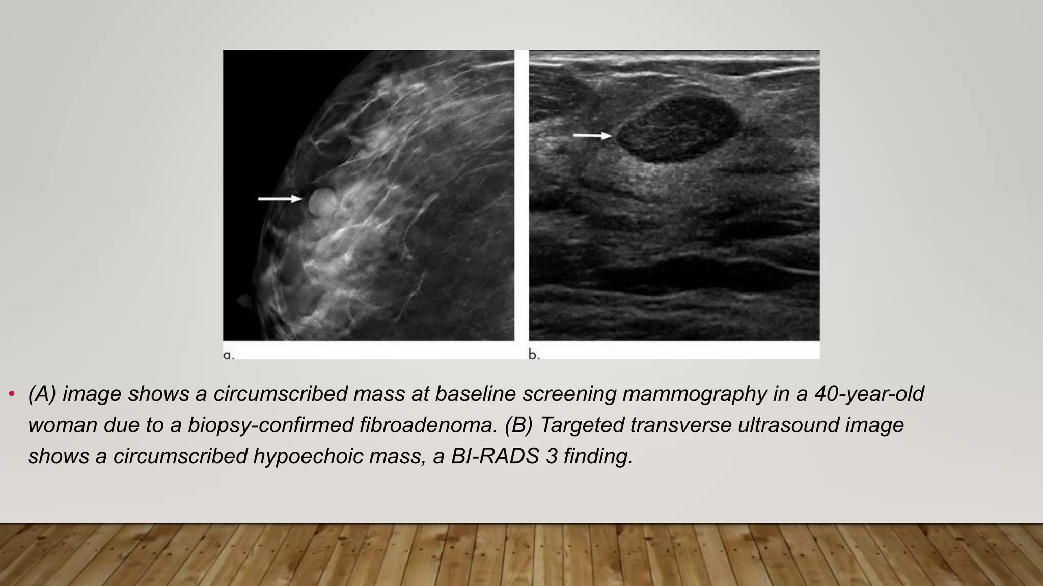 Birads classification of breast.pptx