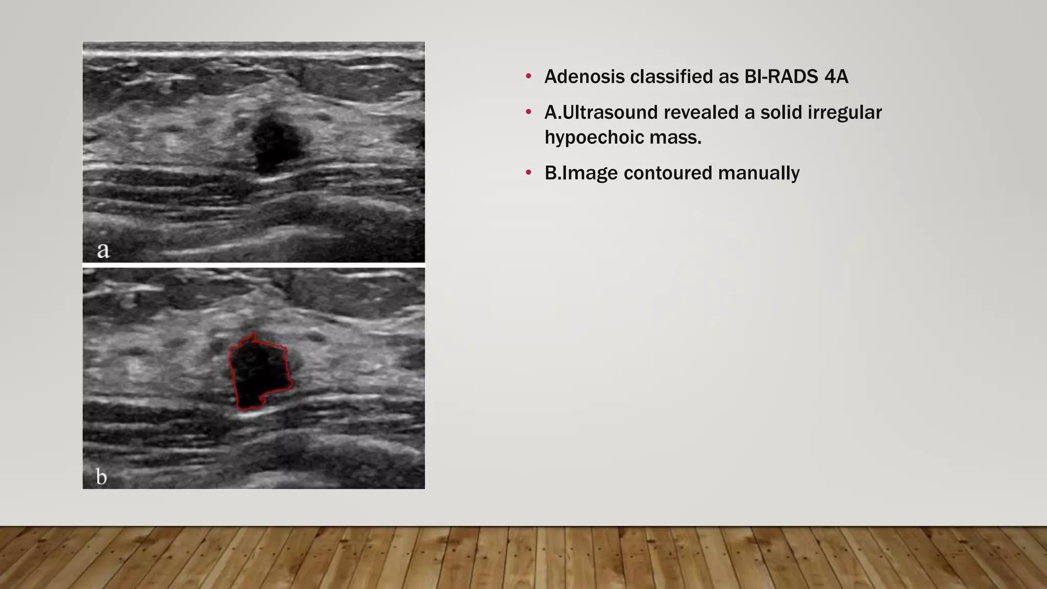 Birads classification of breast.pptx