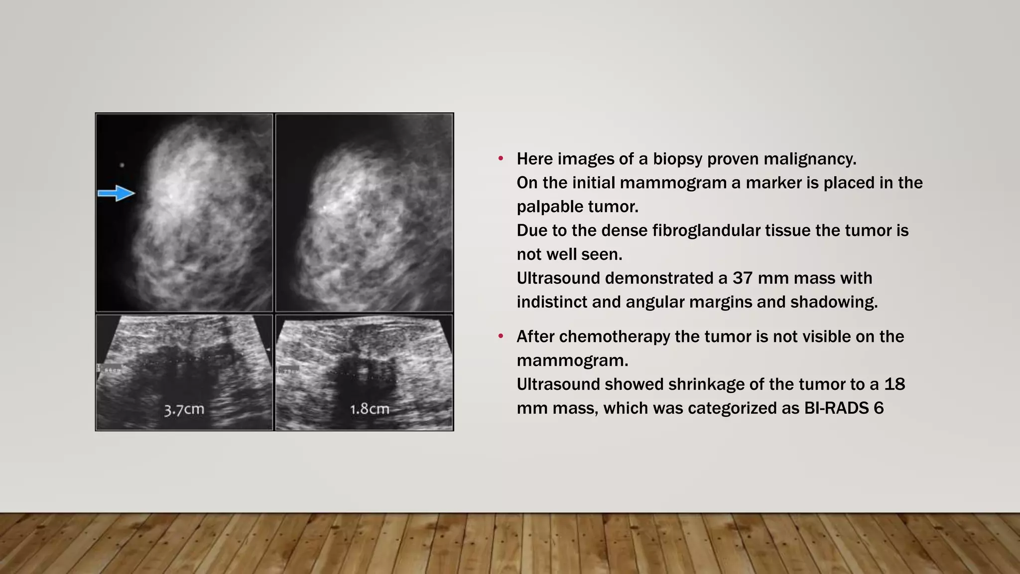 Birads classification of breast.pptx