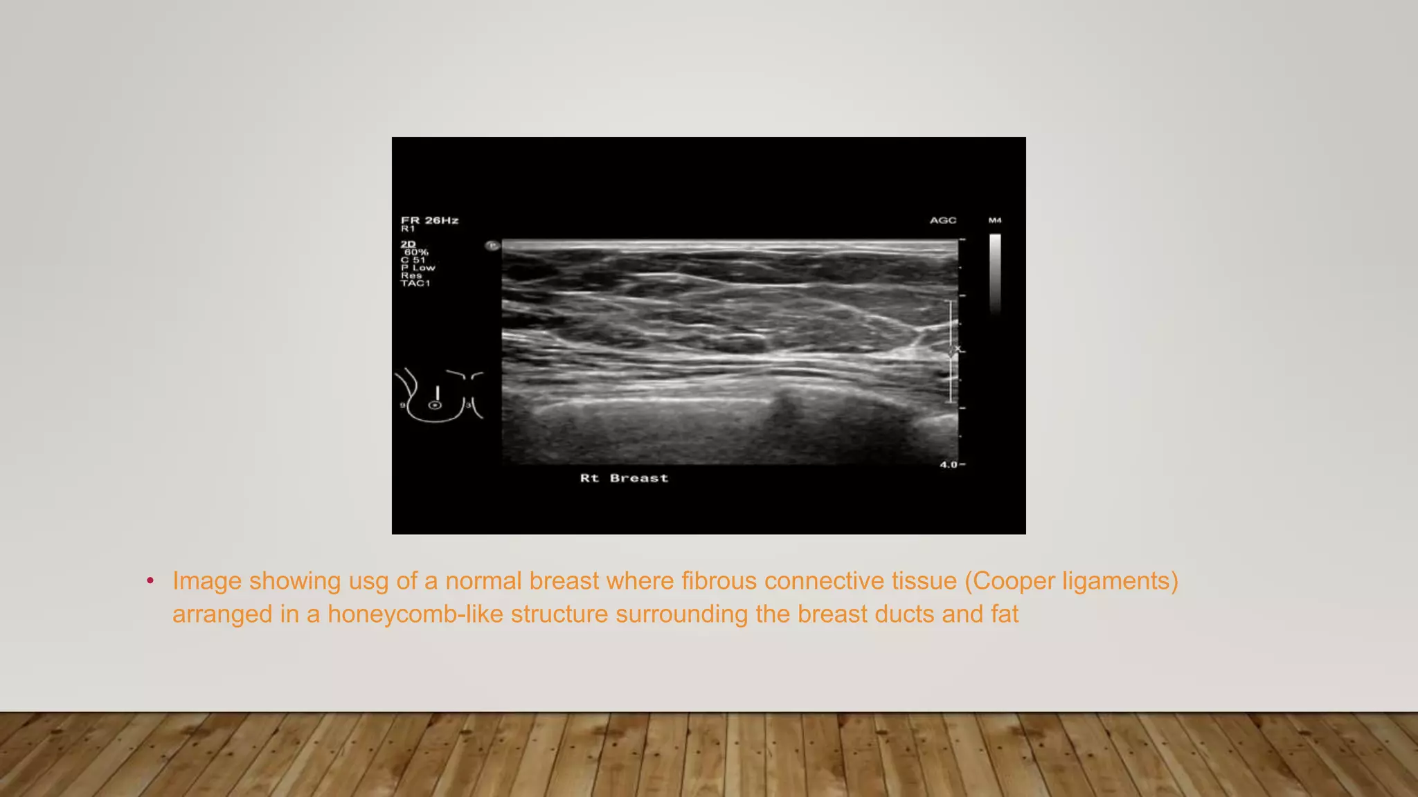Birads classification of breast.pptx