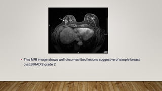 Birads classification of breast.pptx