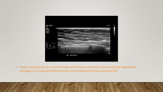 Birads classification of breast.pptx | Cancer | Diseases and Conditions