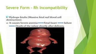 Presentation Rh Incompatibility.pdf