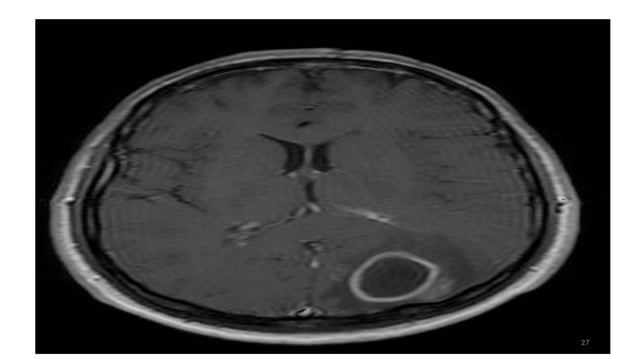 Presentations and management of intracranial abscess | PDF