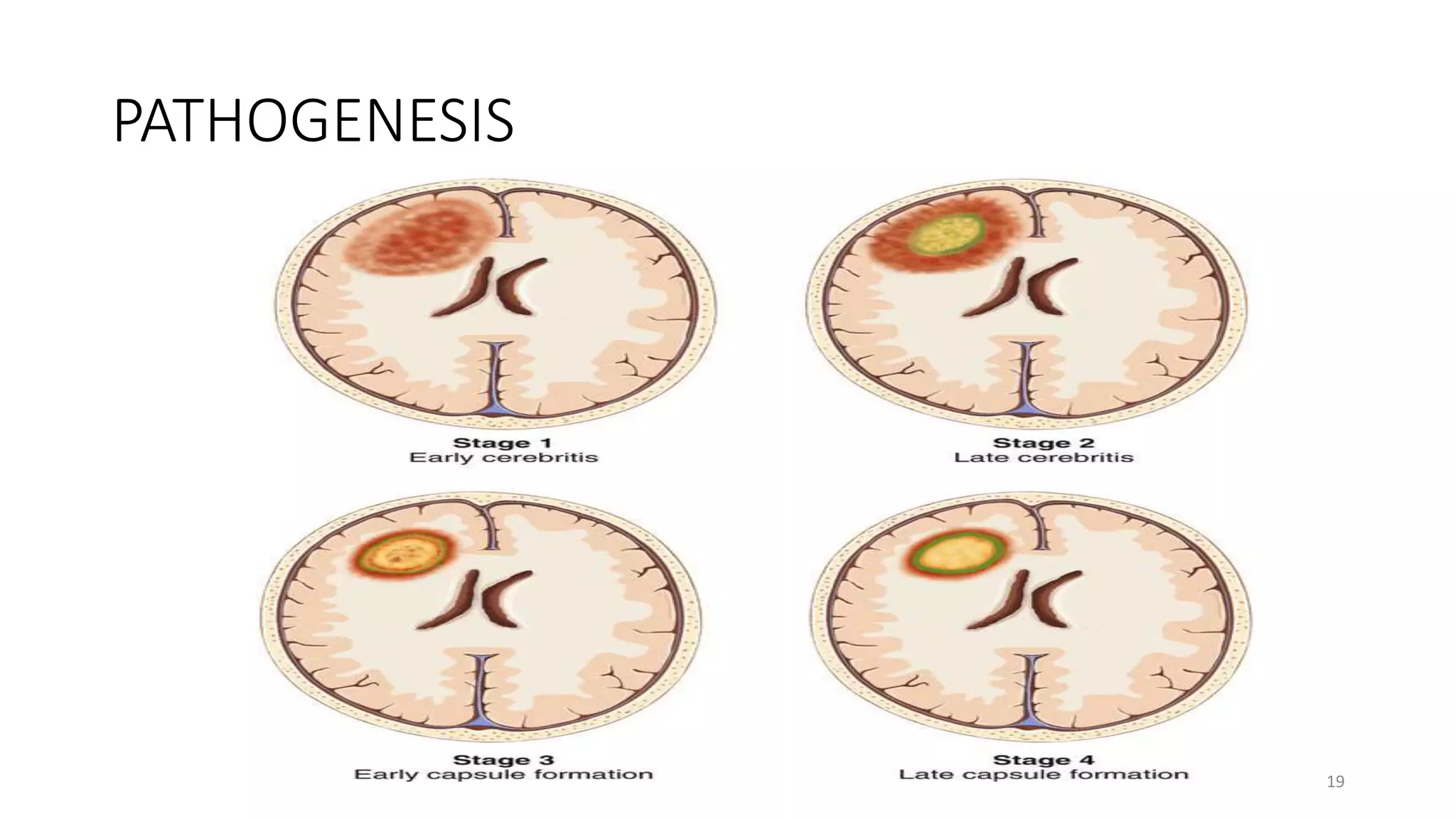 Presentations and Management of Intracranial Abscess.pptx