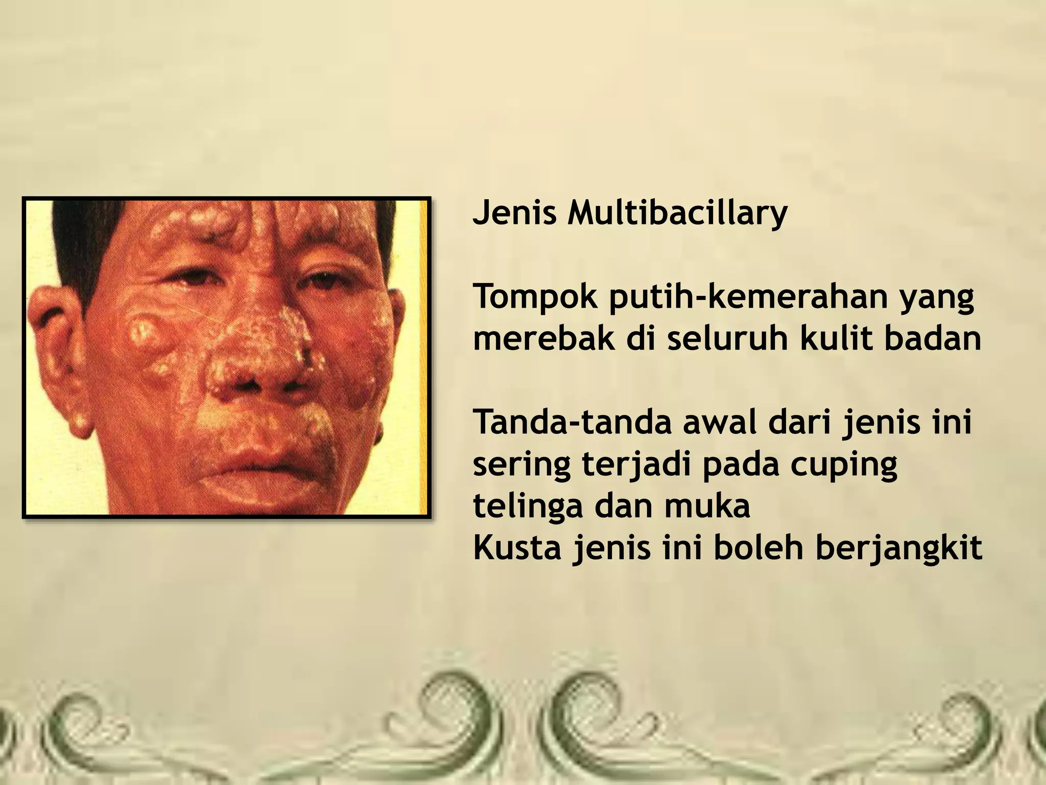 PENYAKIT KUSTA DAN PERKEMBANGANNYA DI MALAYSIA | PPTX