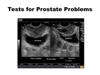 Non medical Management of Prostate - Visual | PPT