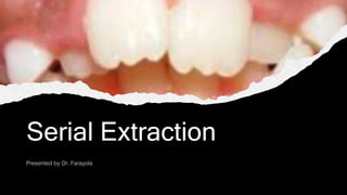 Serial extraction.pptx