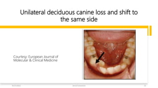 Serial extraction.pptx