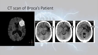 Characteristics of Non Fluent aphasia | PPT