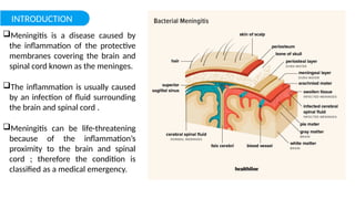 Presentation SOCIAL PHARMACY(Meningitis).pptx