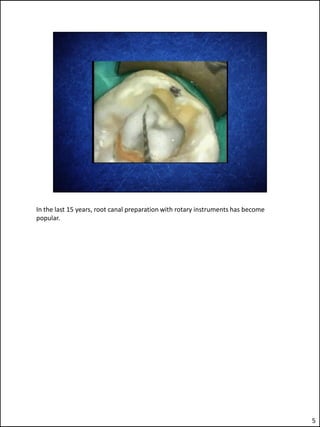 Flat-oval root canal preparation with Self-Adjusting File instrument: a ...