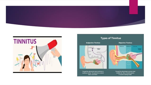 Presentation (Tinnitus).pptx Tinnitus disease is a ear disorder | PPTX