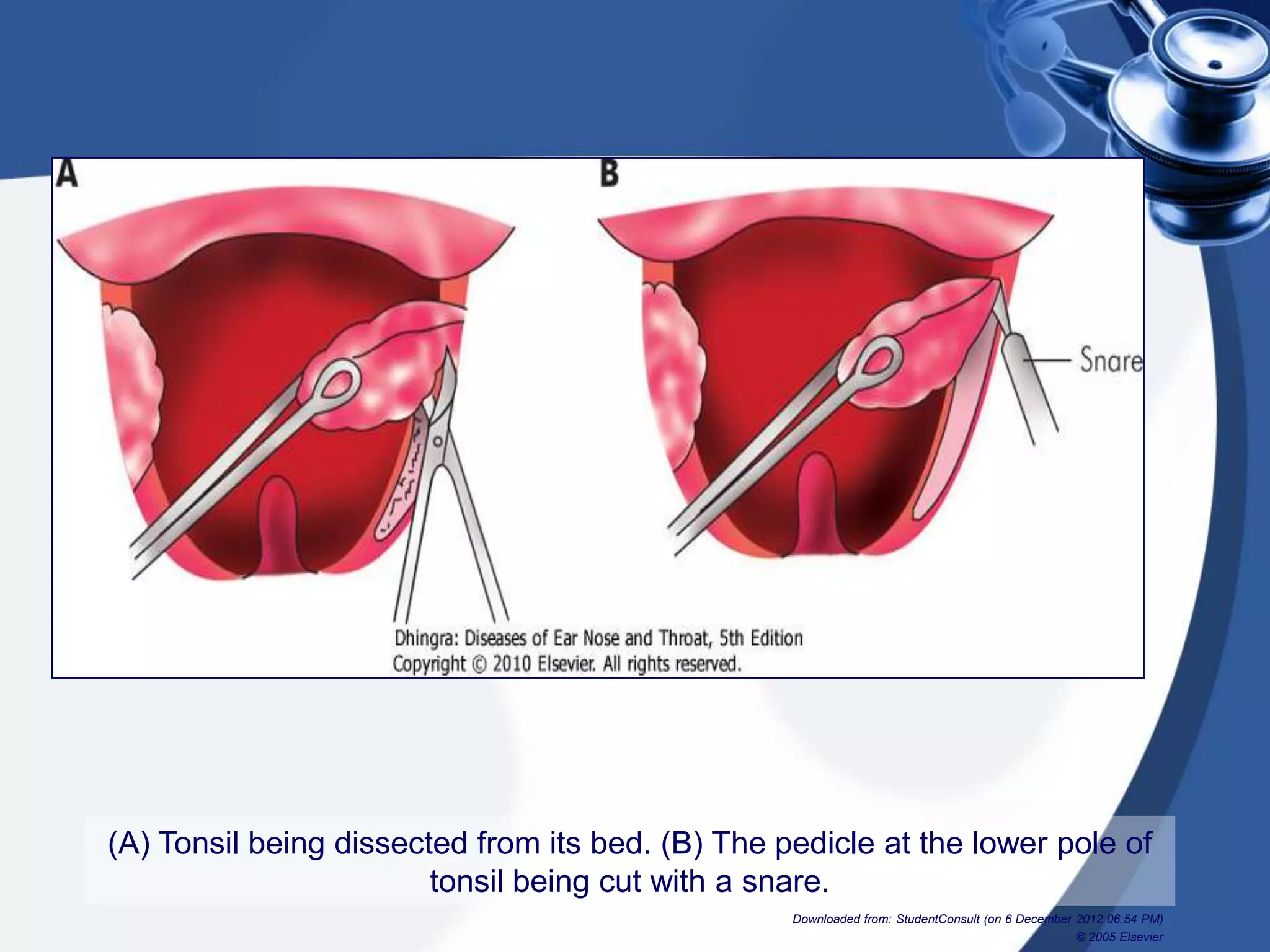 Tonsillectomy | PPTX