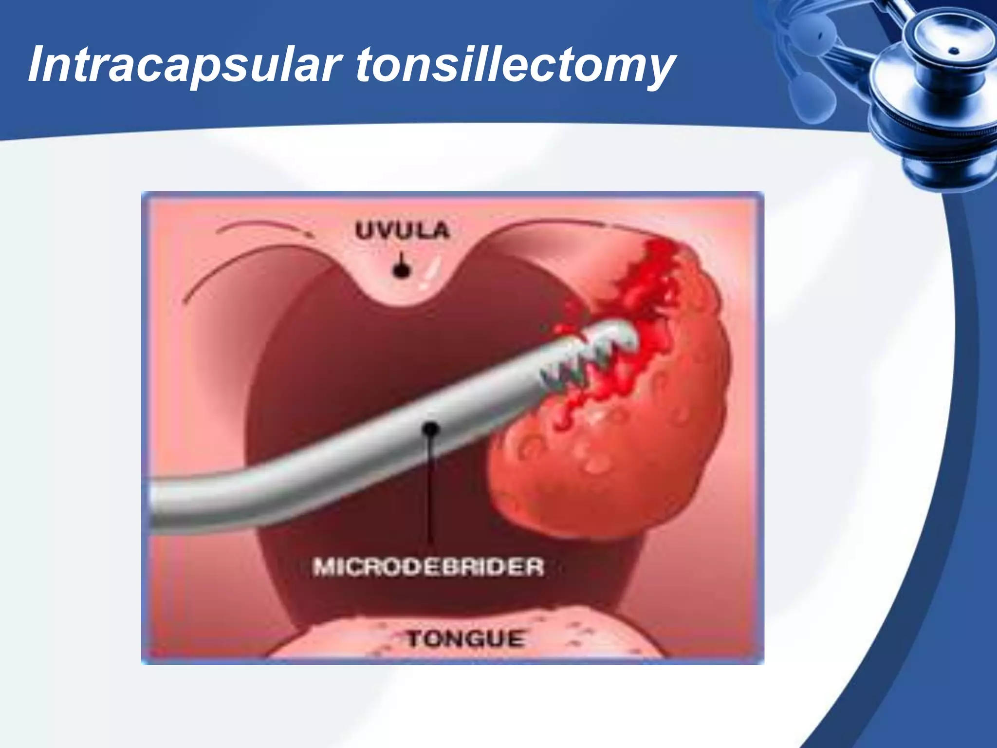 Tonsillectomy | PPTX