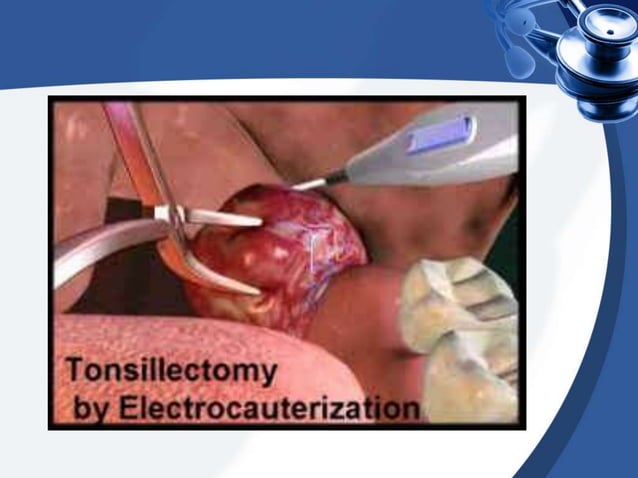 Tonsillectomy | PPTX | Ear, Nose and Throat Conditions | Diseases and Conditions