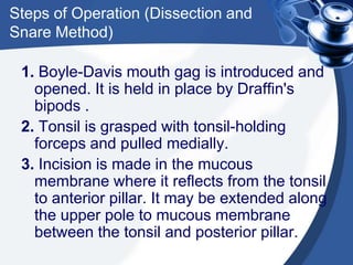 Tonsillectomy Procedure Step By Step