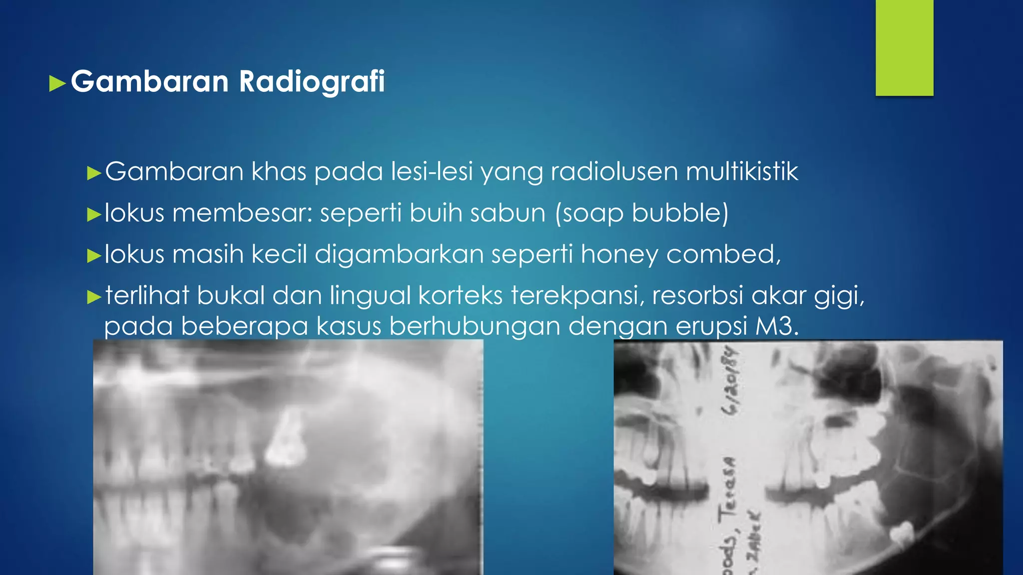 Presentasi Kista Odontogenik dan Tumor Odontogenik - Willi Fragcana ...