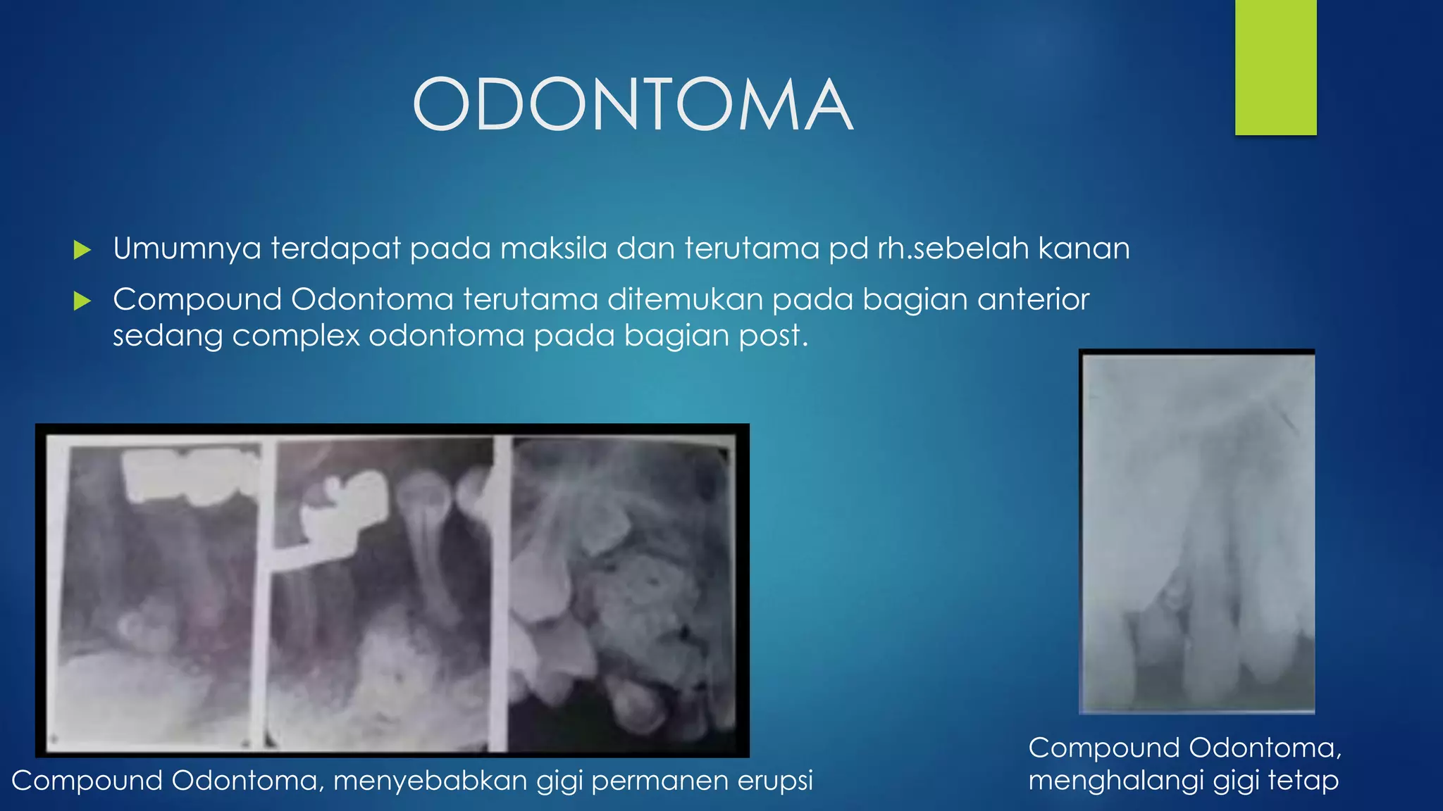 Presentasi Kista Odontogenik dan Tumor Odontogenik - Willi Fragcana ...