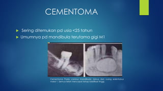 Presentasi Kista Odontogenik dan Tumor Odontogenik - Willi Fragcana ...