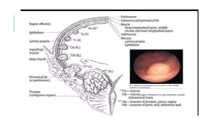 bladder preservation - Bladder Cancer .pptx