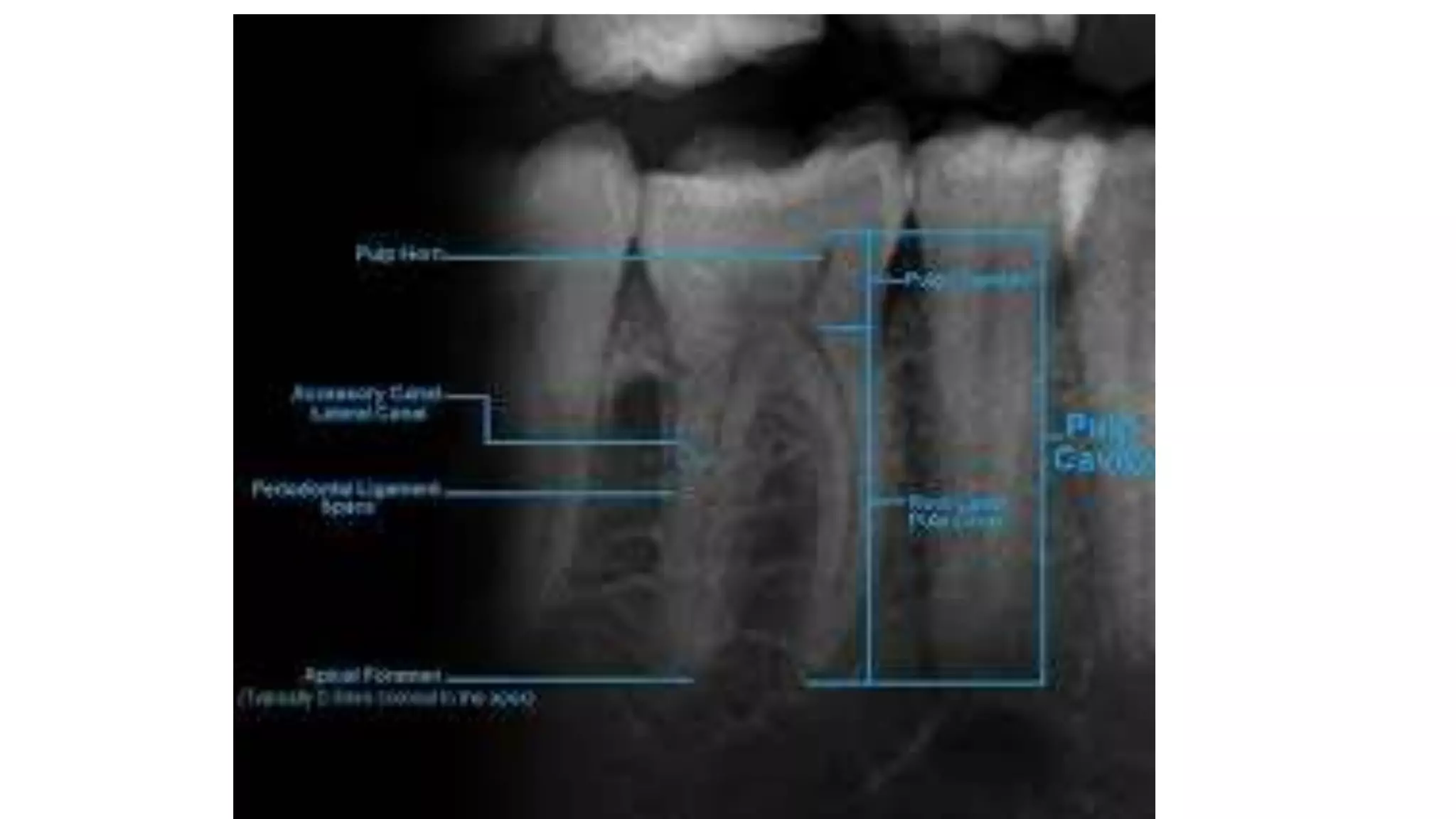 Presentation Maxillary canine | PPTX