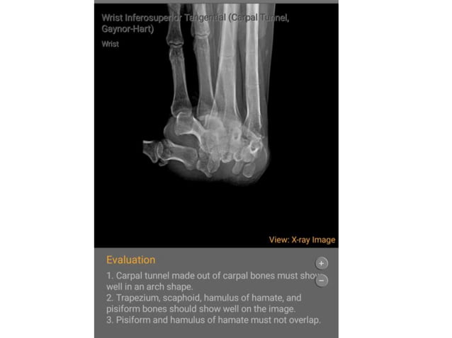 Presentation UPPER LIMB.pptx it is about x ray positioning of upper ...