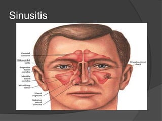 upper respiratory tract infection | PPTX