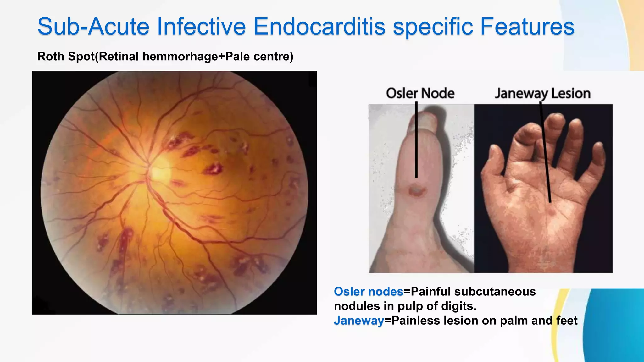 Infective Endocarditis | PPTX