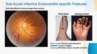 Infective Endocarditis | PPT