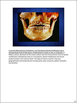 Evidence of pulp disease in the inlayed teeth of the ancient Mayans: a ...