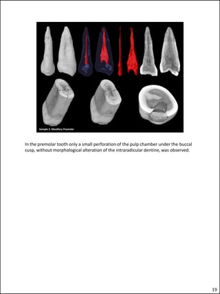 Evidence of pulp disease in the inlayed teeth of the ancient Mayans: a ...