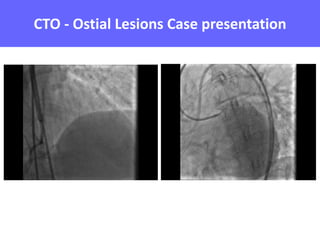 Valeri Gelev - Ostial CTO Lesions | PPT