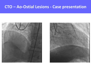 Valeri Gelev - Ostial CTO Lesions | PPT