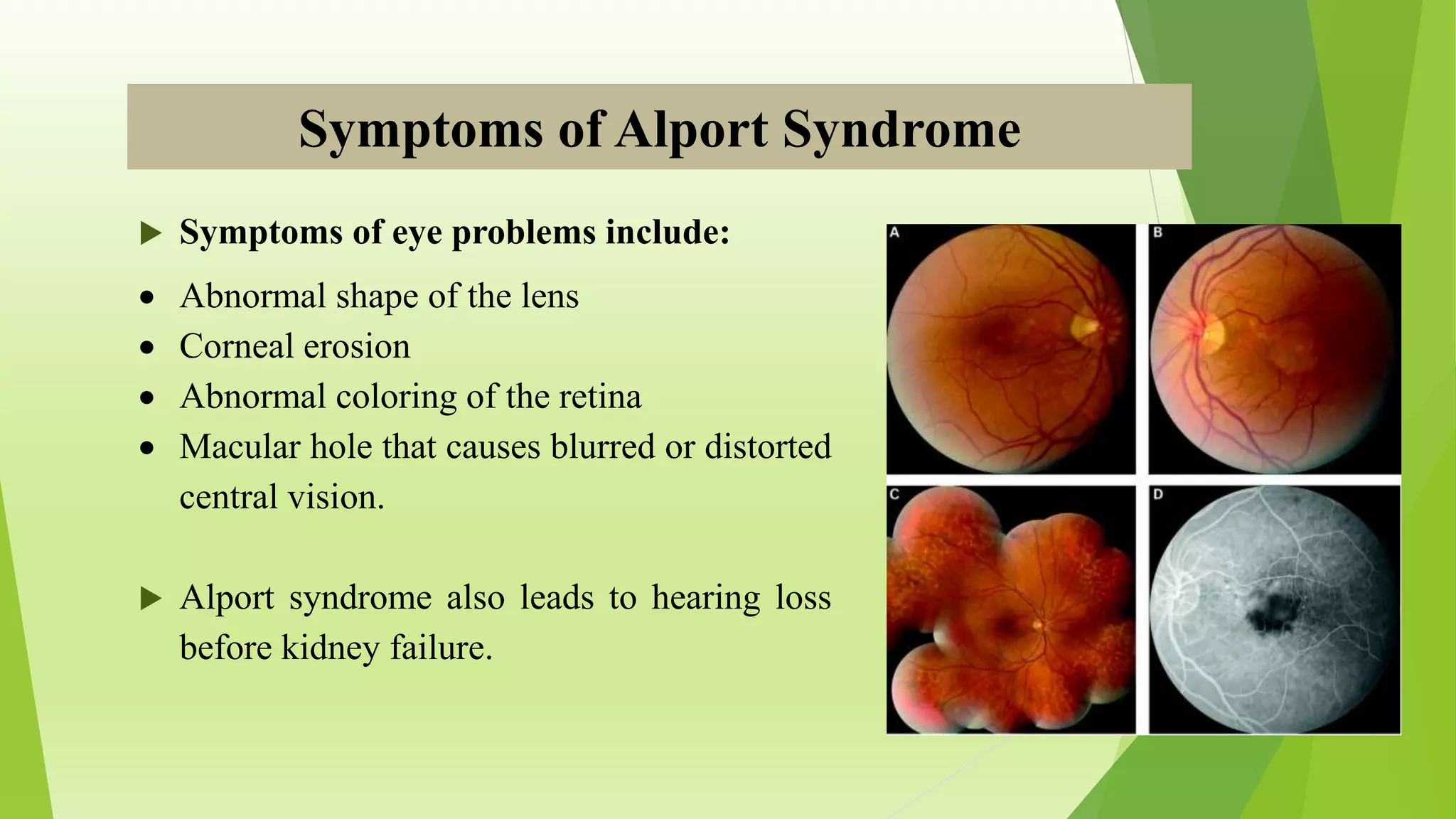 alpoort syndrome.pptx