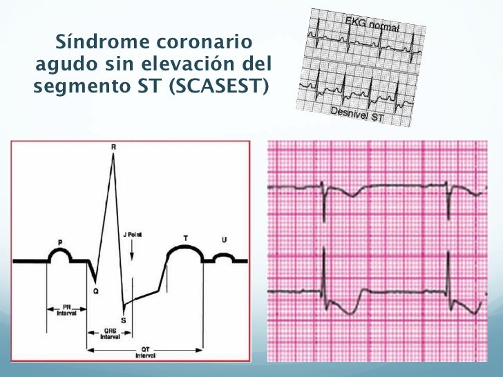 Infarto agudo de miocardio