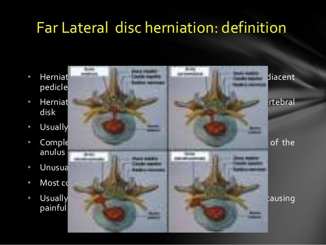 Extreme lateral disc herniation causing lumbar and radicular pain