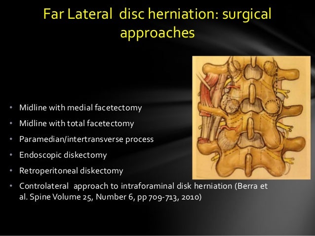 Extreme lateral disc herniation causing lumbar and radicular pain