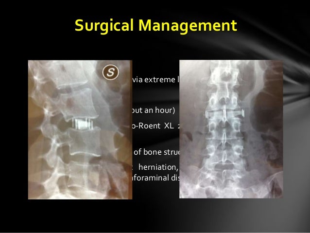 Extreme lateral disc herniation causing lumbar and radicular pain